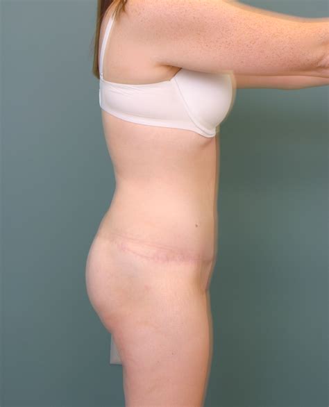 Knoxville Gluteal Enhancement Cosmetic Surgery Before And After The