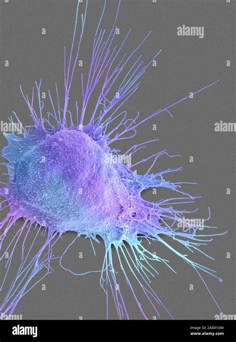 Prostate Cancer Cell Coloured Scanning Electron Micrograph Sem Such Cells Can Clump To Form