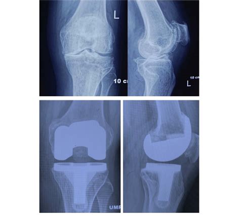 Pre And Post Operative Radiographs Of Tka Pfc Sigma Ps For Medial Oa Download Scientific