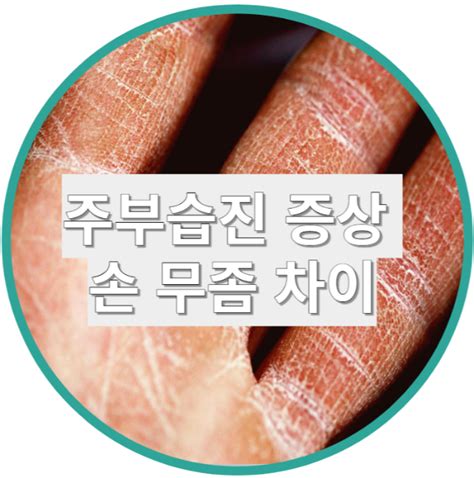 주부습진 증상 손 무좀 차이
