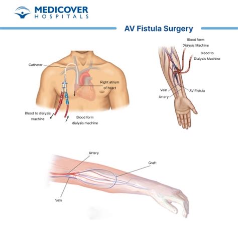 Av Fistula Surgery Procedure Preparation And Recovery