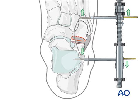 Primary Fusion Of Unreconstructable Calcaneocuboid Joint