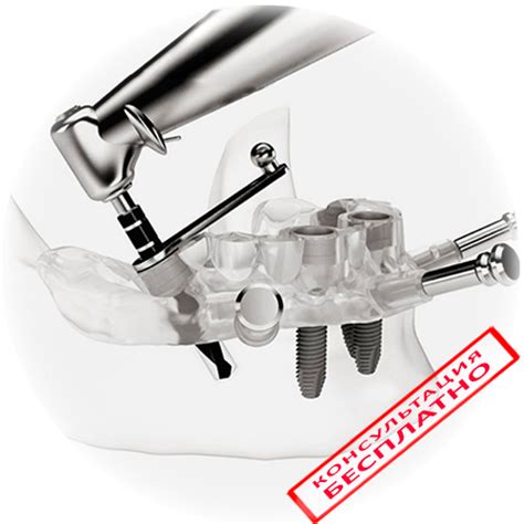 All-On-4 без хирургического шаблона: когда. зачем и как применяется ...