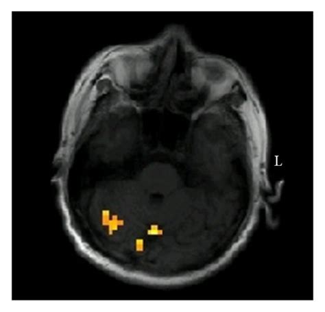 Longitudinal Observation Of Brain Activation In Case 3 During The Download Scientific Diagram