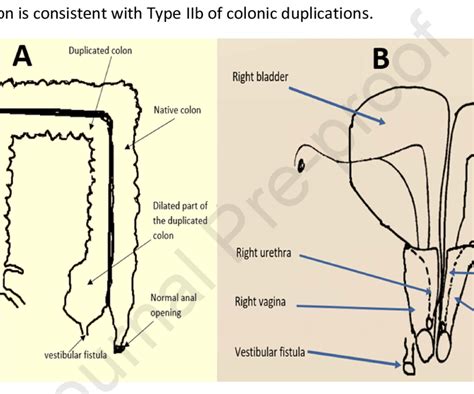 Schematic Demonstration Of Colon Duplication A And Genitourinary Download Scientific Diagram