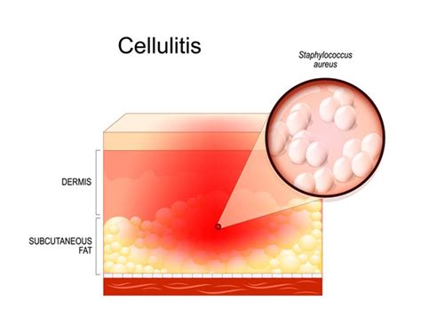 Understanding Cellulitis Key Symptoms And What They Mean For Your