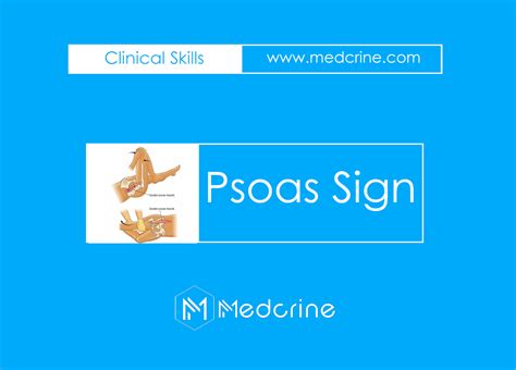 Psoas Sign Medcrine