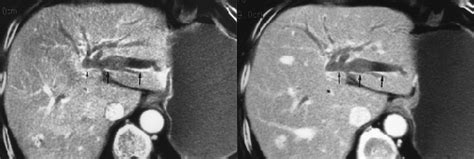 A 72 Year Old Woman With Recurrent Pyogenic Cholangitis Without Acute