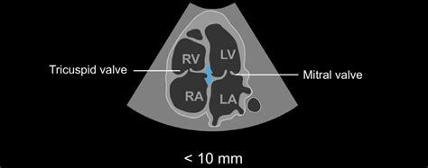 Echo Basics Tricuspid Valve • Litfl • Radiology Library