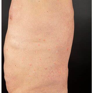 Numerous Edematous Erythematous And Well Demarcated Papules And Download Scientific Diagram