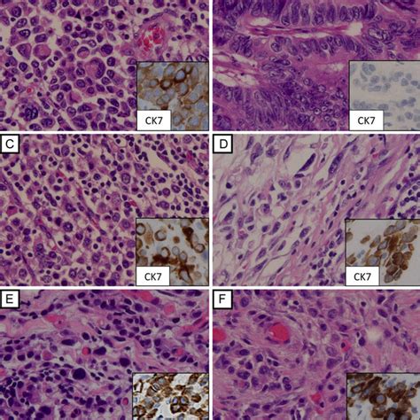 Reported Cases Of The Gastric Cancer Metastasizing To The Lymph Nodes