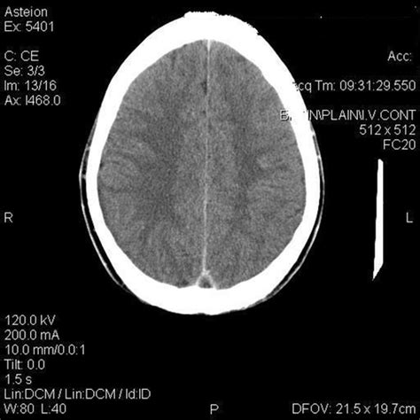 Intracranial Venous Thrombosis Flashcards Quizlet