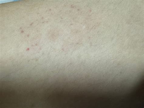 피부에 붉은 반점과 가려움 부어오름 지식in