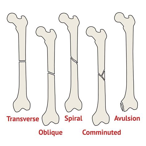 Types Of Bone Fractures