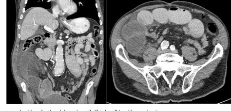 Figure 1 From Intestinal Obstruction Caused By Pericecal Internal
