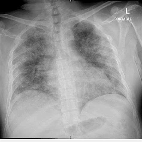 Cxr Showing Bilateral Reticular Opacities Consistent With Multifocal