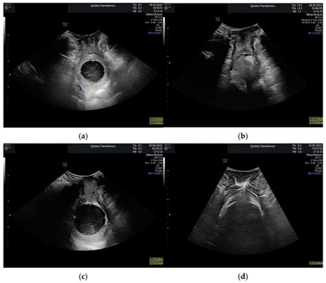 Membrane Status And Reliability Of Intrapartum Transperineal Ultrasound