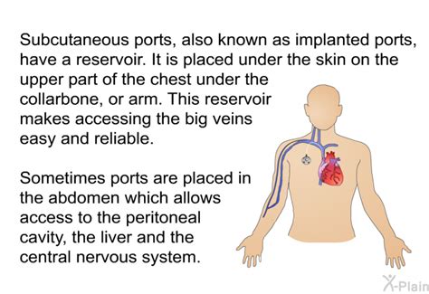 Port Catheter Insertions