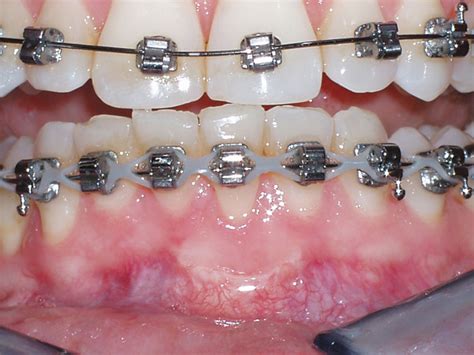 Free Gingival Grafting Austin Dentist Mike Williamson Dds Ms