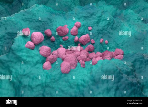 Non Small Cell Lung Cancer Nsclc In The Lung Tissue Isometric View 3d Illustration Stock