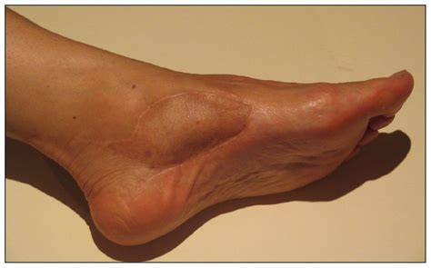 Synovial Sarcoma On Bottom Of Foot On Sale