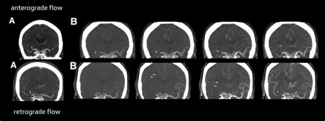 Collateral Circulation Assessment Stroke Manual