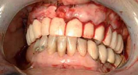 The Occlusion At The End Of The Operation Download Scientific Diagram