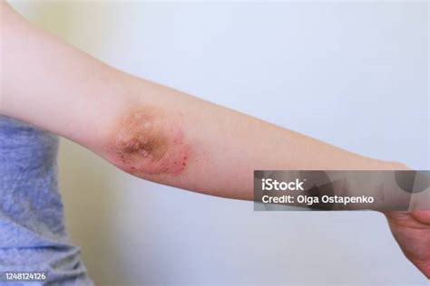 Atopic Dermatitis On Women Hand Elbow Joint Eczema Allergies Skin