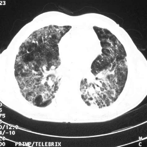 Ct Scan Of The Lungs Axial View Showing Greatly Abnormal My XXX Hot Girl