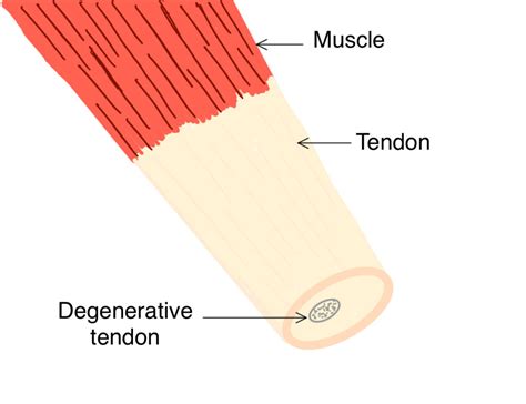 Tackling Tendon Pain The Basics Explained MTI Physical Therapy