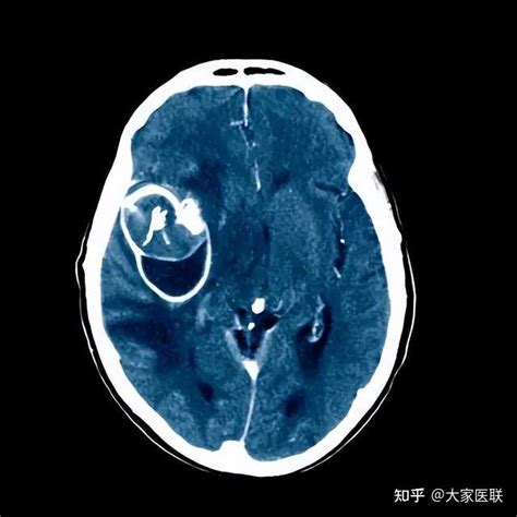 查肝脏，选b超好还是ct好呢？哪个结果准确度更高？ 知乎