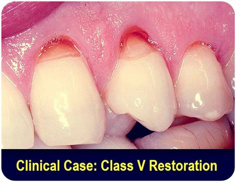 Class V Restoration Clinical Case Dr Ahmed Khairy