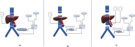 Principles Of In Situ And Ex Situ Cold Perfusion Under Tve Venovenous Download Scientific