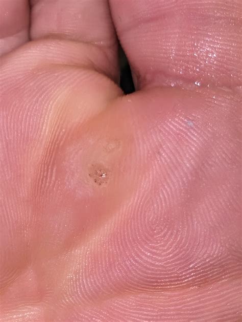 Recurring Plantar Wart Excision From My Foot Rmedizzy