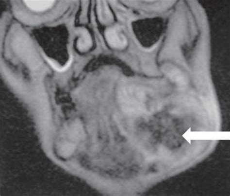 Intramedullary Osteosarcoma Of The Mandible A Clinicoradiologic Perspective Journal Of