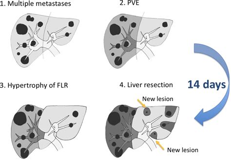 Safe Hepatic Lobectomy Using Portal Vein Embolization For The Treatment