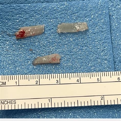 Cartilage Graft Harvested From The Nasal Septum Download Scientific