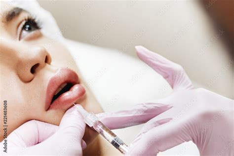 The Process Of Lips Enhancement Cosmetician Makes An Injection Of Hyaluronic Acid In A