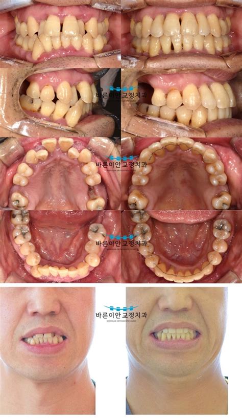 심한치주질환으로 인한 치아상실을 동반한 Iii급 부정교합 환자의 교정치료 전주교정치과 전주치아교정 네이버 블로그