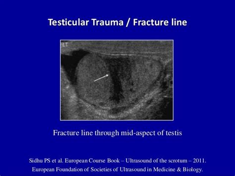 Testicular Rupture Ultrasound Testicular Rupture A Sagittal
