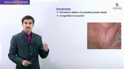 Vascular Ectasias Nevus Flammeus Port Wine Stain Salmon Patch
