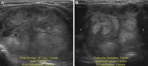 Us Risk Stratification System For Follicular Thyroid Neoplasms Radiology
