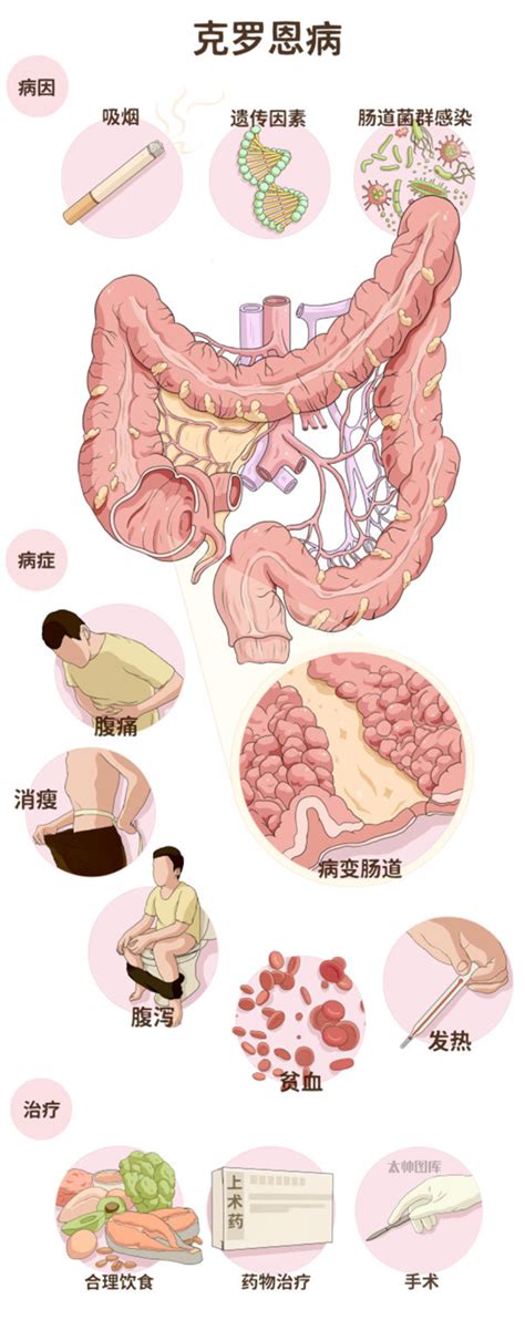 克罗恩病 医学插画