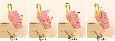 Structure Of Supratrochlear Nerve Semantic Scholar