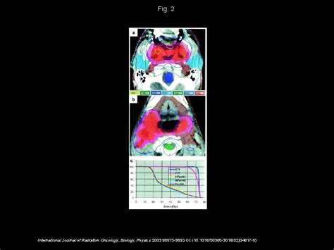Simultaneous Integrated Boost Intensitymodulated Radiotherapy For Locally Advanced