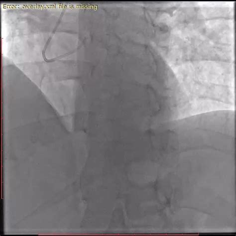 Pavel Somov On Linkedin Pci Lm Isr Ivus Bifurcation