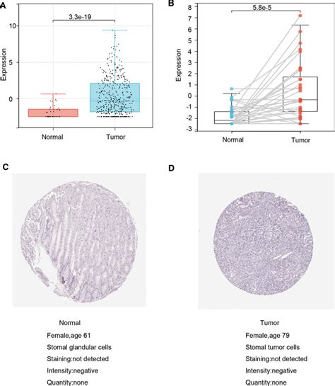 Multiple Bioinformatics Analysis Identifies IGFBP As Associated With The Prognosis Of Stomach
