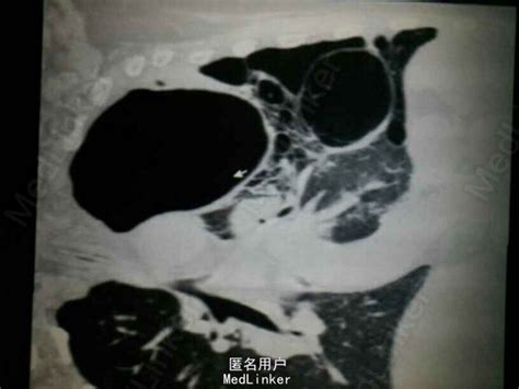 复杂肺大泡一例分析 医联