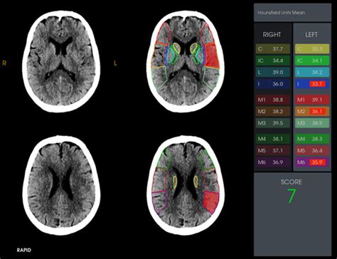 Solitaire 3x20 And 6x40 In Simultaneous 2 Branch Occlusions With Tici