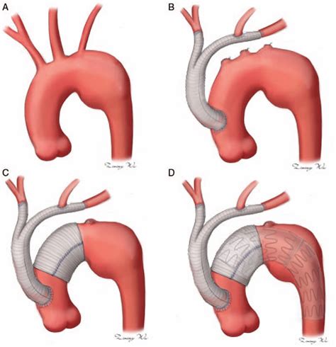 Debranching Thoracic Endovascular Aortic Repair Combined Wit Chinese Medical Journal